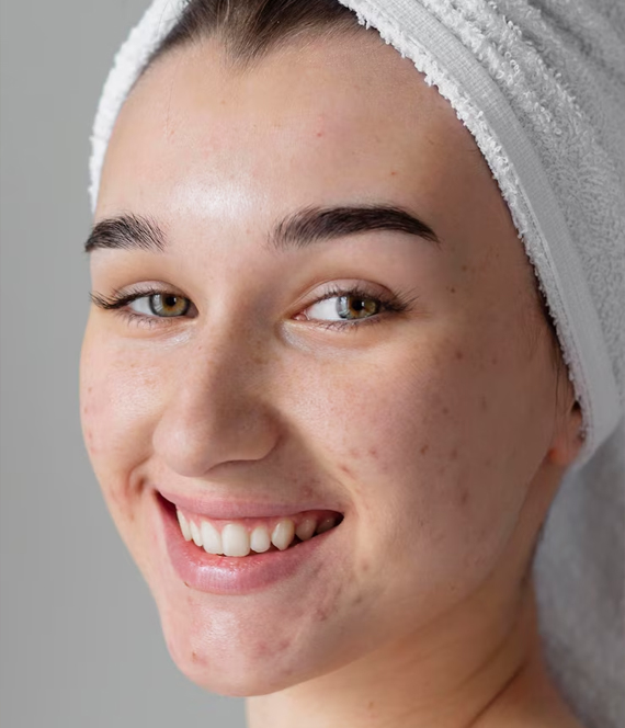 Acne Scar Treatment | Skin Scarring Solutions